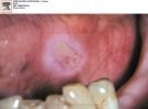 Lesões Ulcerativas e VesicoBolhosas | Odontologistas