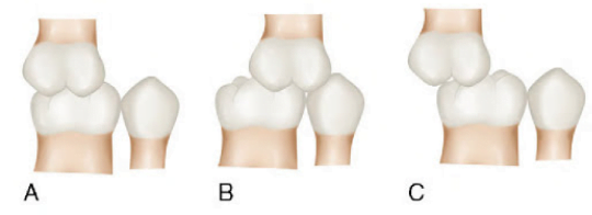classe angle | Odontologistas
